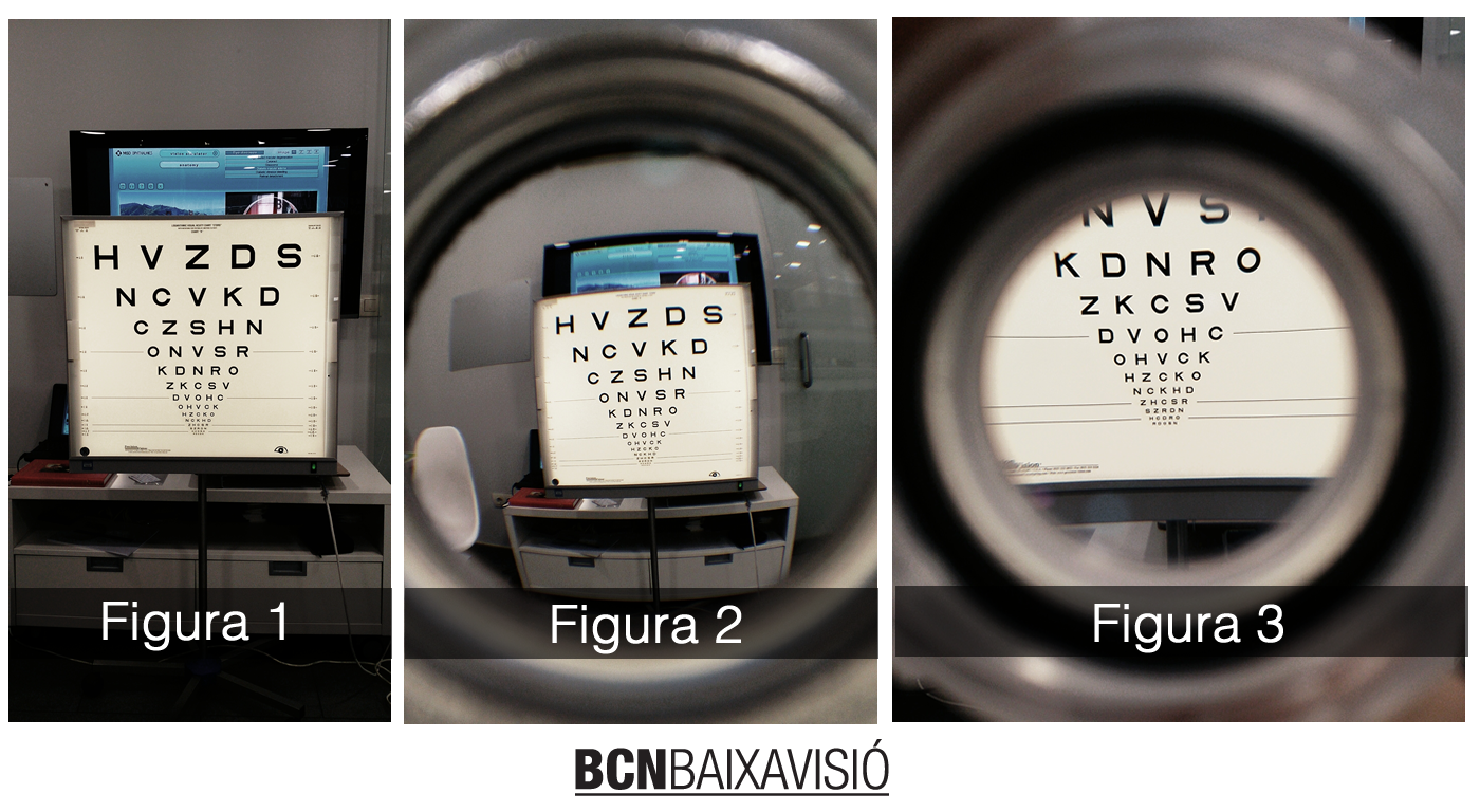 Aumento para pacientes con Baja Visión | BCNbaixavisio